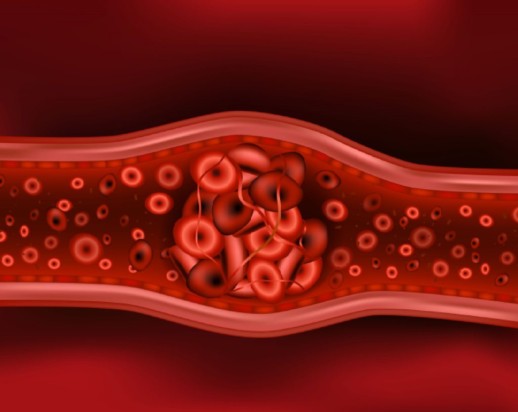 Embolia pulmonar: ¿Qué es?