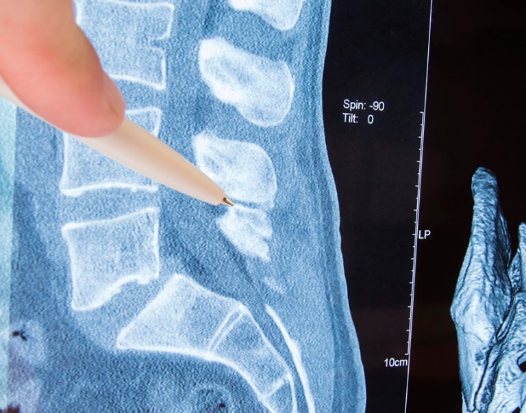 Discartrosis lumbar: ¿Qué es y cómo afecta a tu salud?