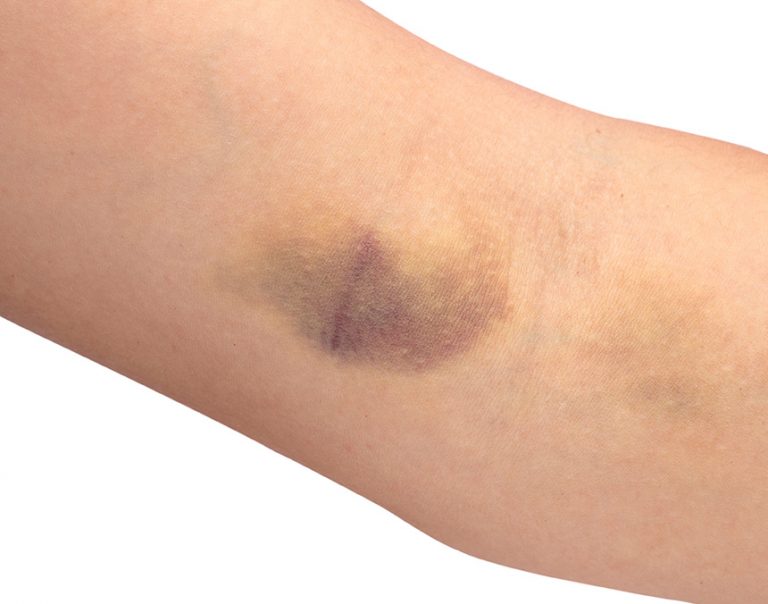 Diferencias entre un moretón común y un hematoma grave
