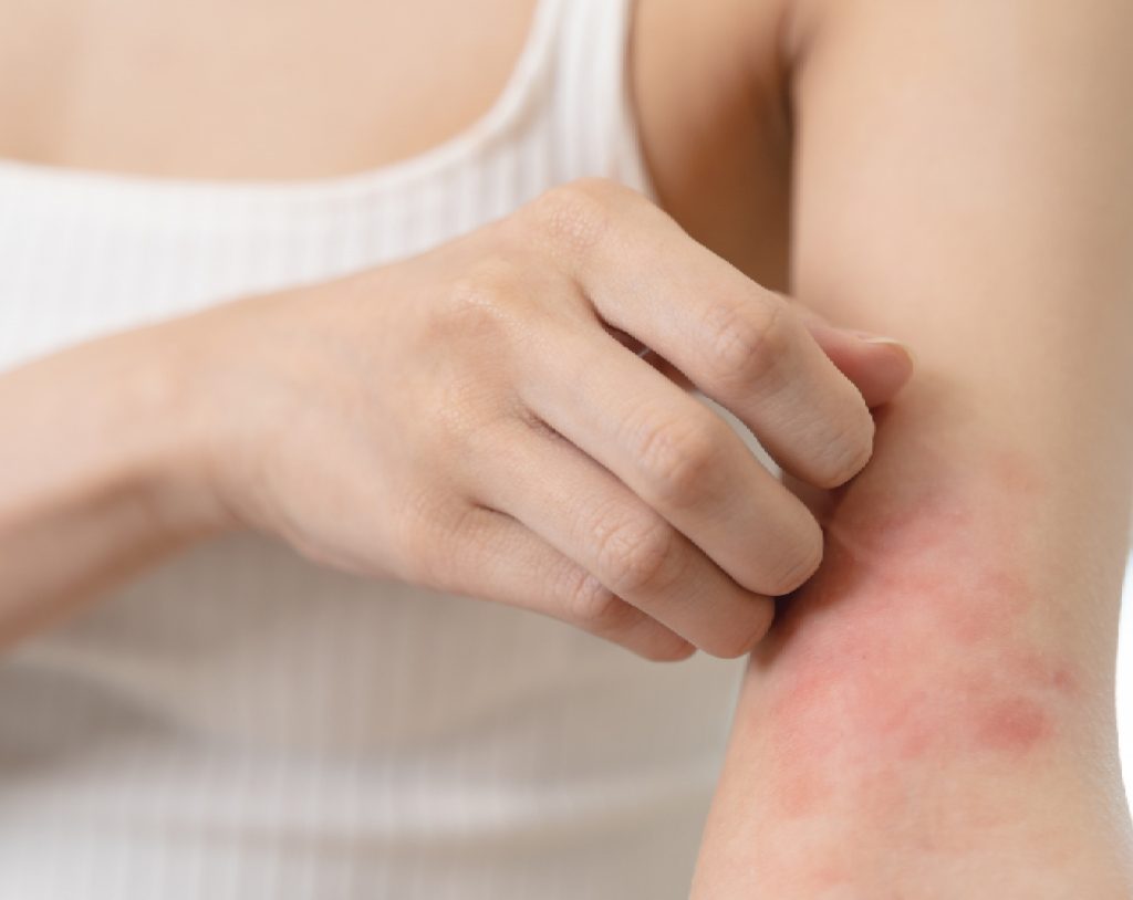 Dermatitis Atópica | Definición, síntomas y tratamiento