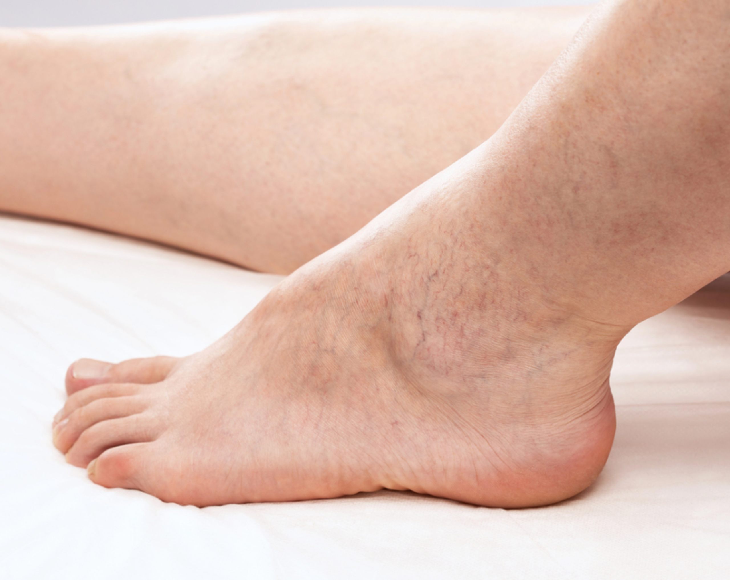 Insuficiencia venosa crónica, ¿qué es?