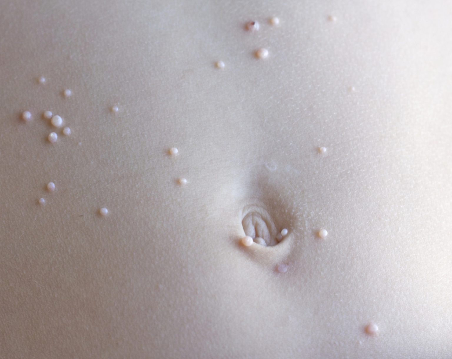 Molusco contagioso: ¿cuál es el tratamiento?